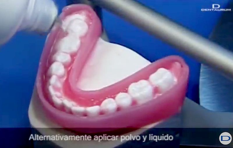 OCLUSIÓN: Orthocryl® - Férula oclusal con la técnica de rociado paso a paso