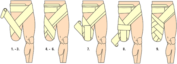EXCLUSIVE PHYSIOTHERAPY GUIDE FOR PHYSIOTHERAPISTS: STUMP BANDAGING FOR ...