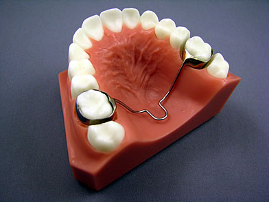 Beugelbekkie: De beugel is geplaatst.