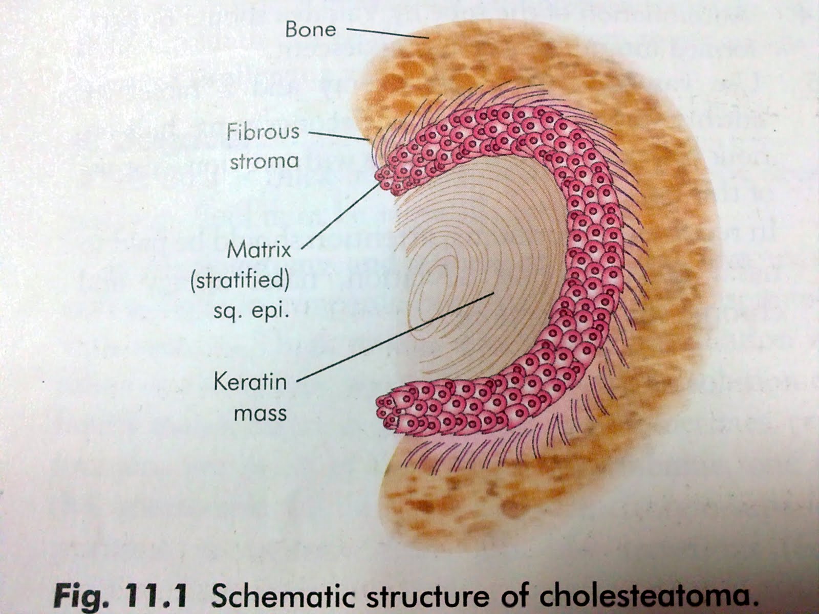 LIVE ur LIFE with EXPERIENCES: CHOLESTEATOMA