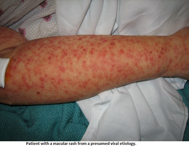 chikungnya: el virus chikungunya