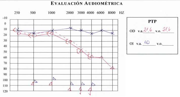 Audiometría: Diagnóstico Audiológico ~ Audiología didáctica para ...