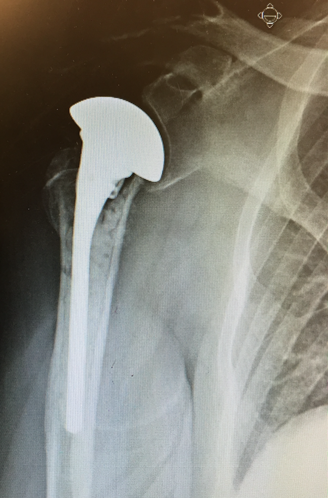 Shoulder and Elbow Surgery: Hemiarthroplasty for proximal humerus fractures