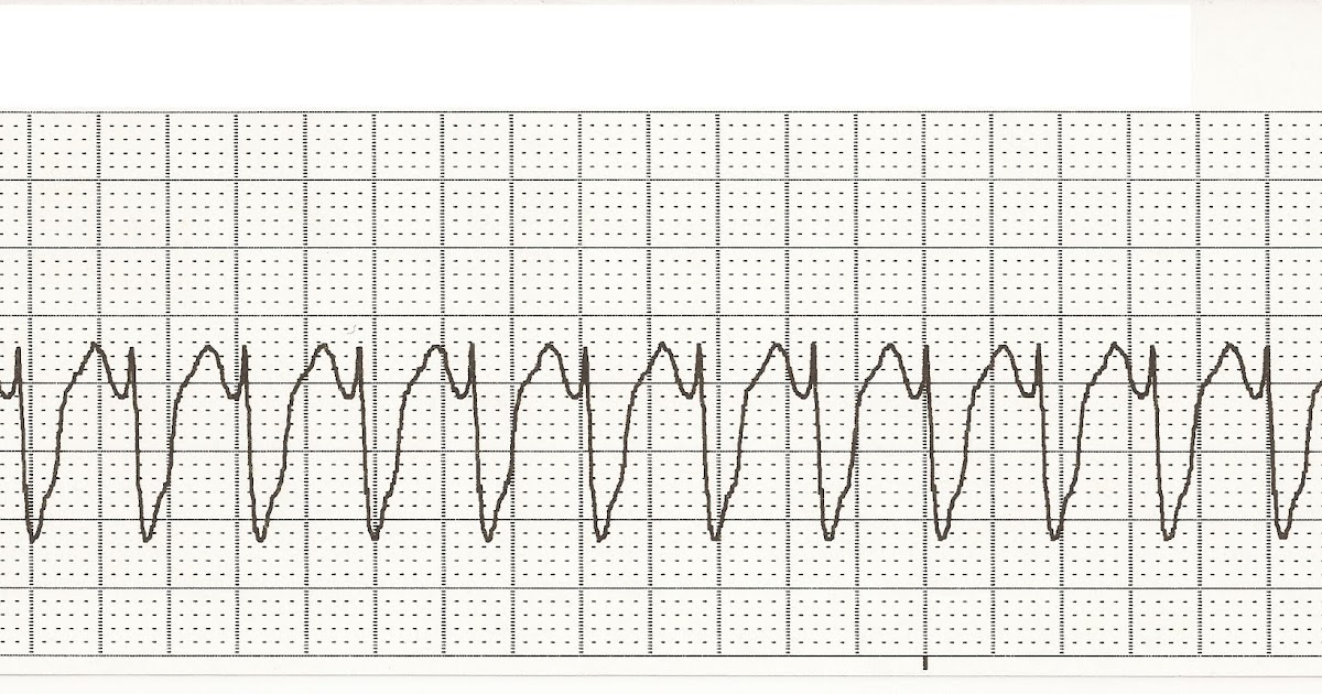 Identify the appropriate electrical intervention for the following EKG ...