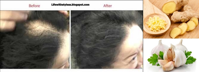 Ginger Garlic for Hair Growth and hair loss prevention - DIY hair loss ...