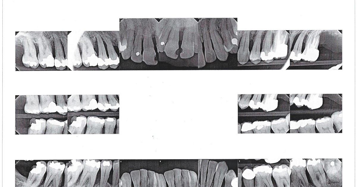 An Englishman in Texas: Traditional English Teeth