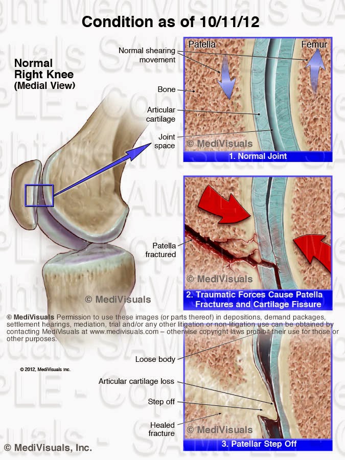 The Medical Legal Exhibit Expert Blog: Complications Associated with ...