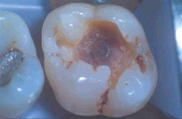 TRATAMIENTOS DENTALES: ¿Qué es la caries dental?