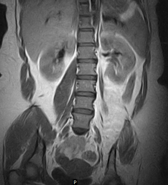 Post Polio Iliopsoas Atrophy-MRI - Sumer's Radiology Blog