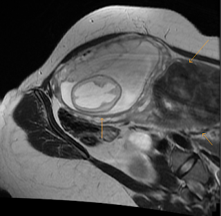 Fetal MRI with Neural Tube Defect - Sumer's Radiology Blog