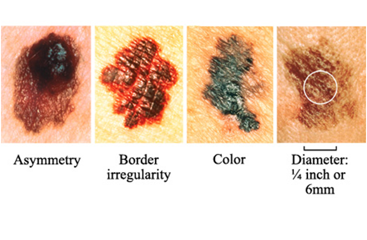 Skin Cancer | Infotaucantik