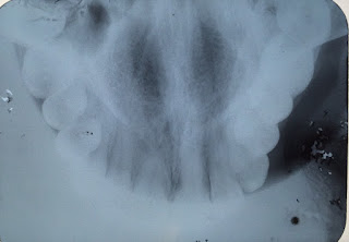 Anahí Chávez: Interpretación Rx Oclusales