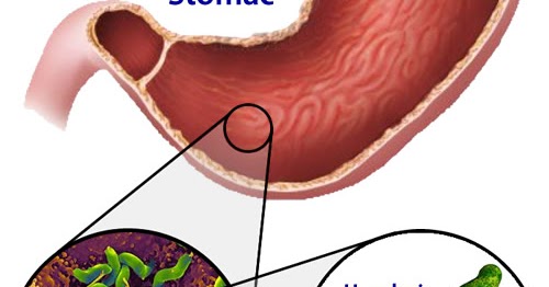 PROBLEMELE LA STOMAC POT FI CAUZATE DE HELICOBACTER PYLORI