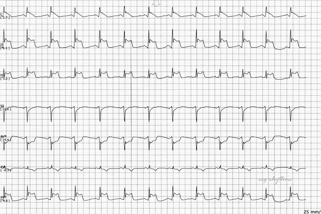 ECG Rhythms: ST elevation in the inferior leads due to wraparound LAD
