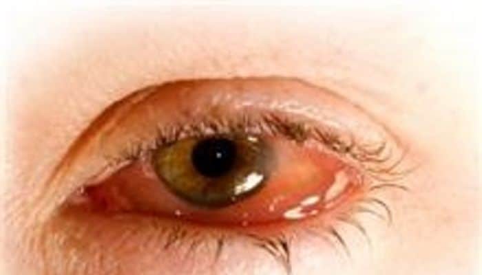 #VisiónAris: ¿Dolor ocular?
