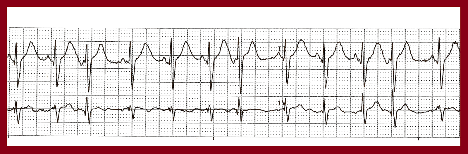 Various Multifocal Atrial Tachycardias