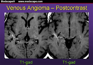 Brain and Spines: Venous angioma