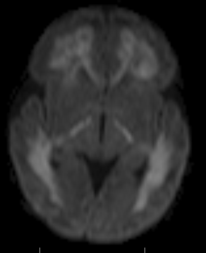 Periventricular leukomalacia -MRI - Sumer's Radiology Blog
