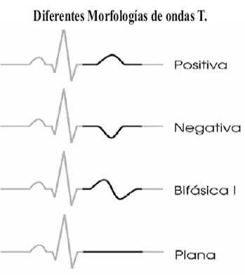 ICC: 2. Electrocardiograma Normal