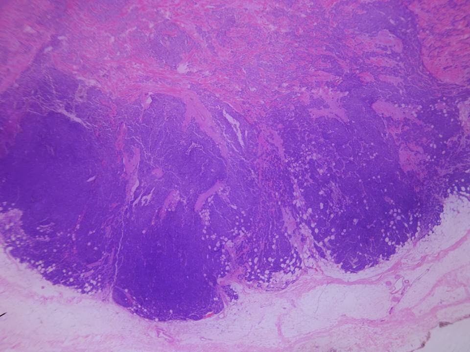 Dermpath Made Simple - Neoplastic: Merkel Cell Carcinoma
