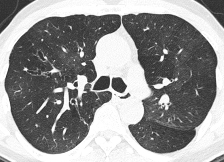 Chest Medicine Made Easy-Dr Deepu: The HRCT findings of Bronchiectasis.