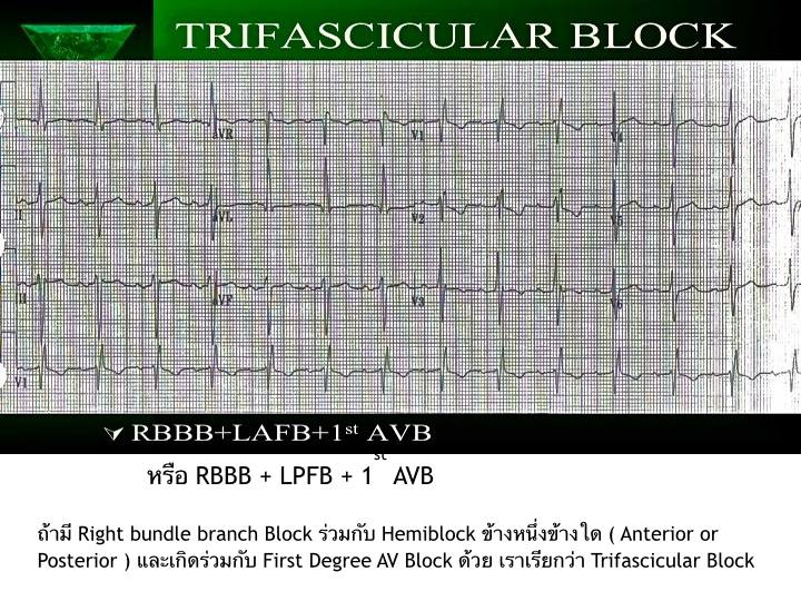 Trifascicular Block คือ