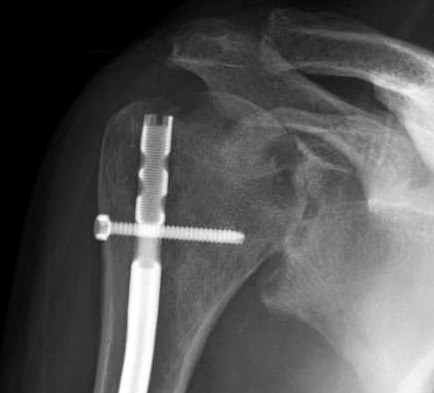 UW Shoulder and Elbow Academy: Septic, infectious arthritis of the ...