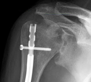 UW Shoulder and Elbow Academy: Septic, infectious arthritis of the ...