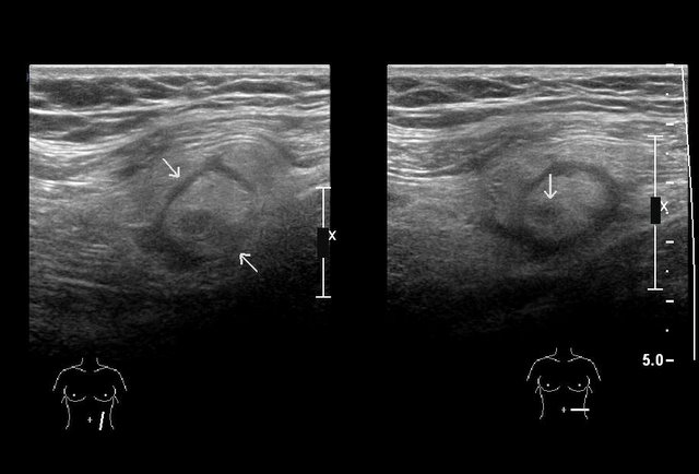 Epiploic appendagitis-Ultrasound - Sumer's Radiology Blog