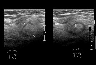 Epiploic appendagitis-Ultrasound - Sumer's Radiology Blog