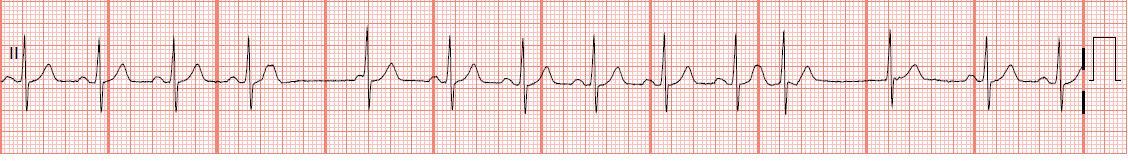 EKG Rhythm Strip Quiz 18