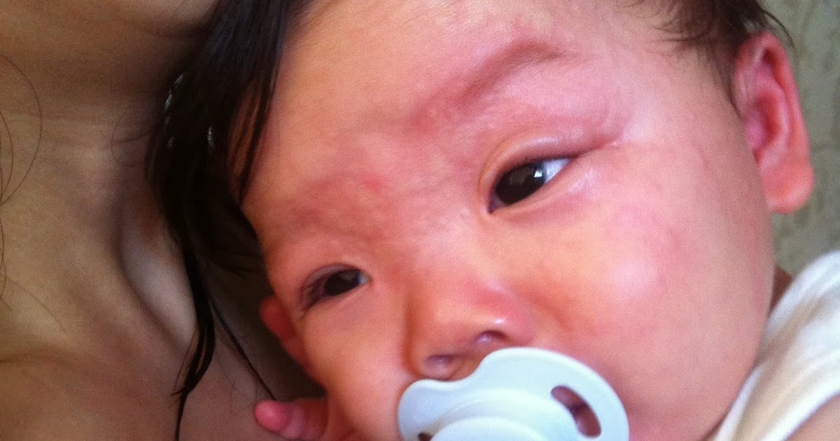 Away with Swells and Hives