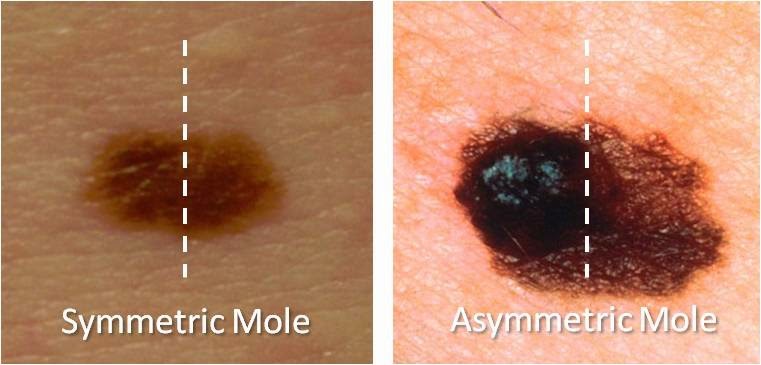 Black is the New Pink - Fight Melanoma: Project Birthday Suit