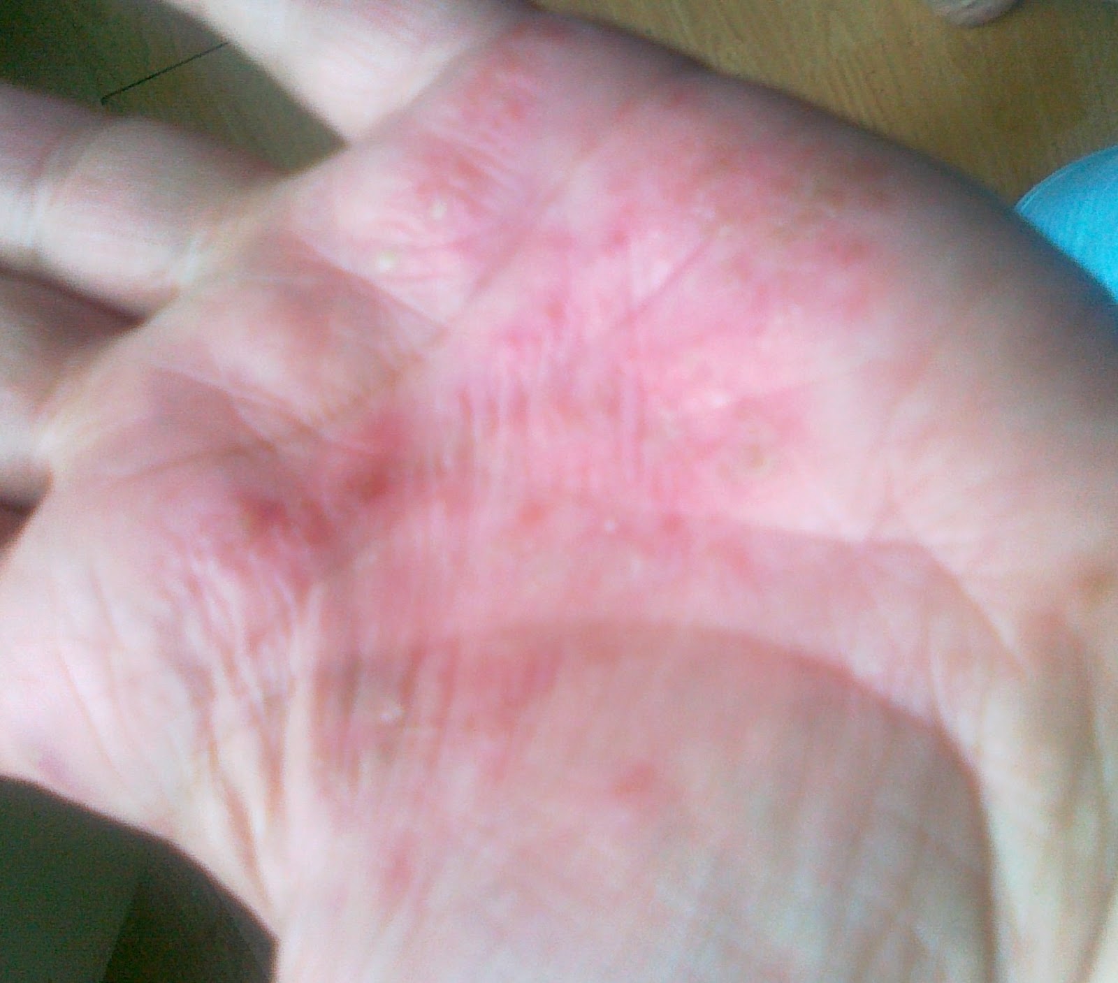 Tuulan turinat: Apua! Käsi-ihottumaa!