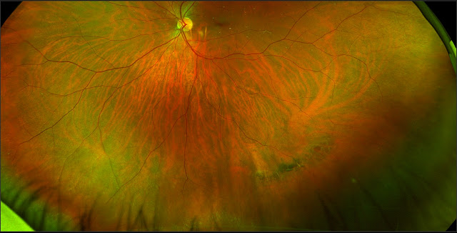 Sonoran Desert Eye Center: ATROPHIC RETINAL HOLE WITHIN LATTICE