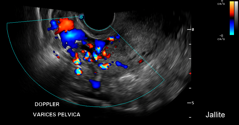 Varices Pelvicas en Paciente con Útero Bicorne