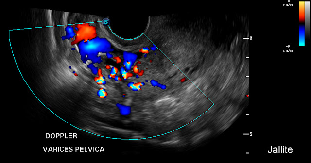 Varices Pelvicas en Paciente con Útero Bicorne