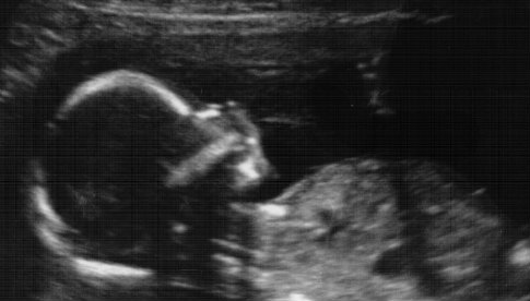 Life and Love in the Petri Dish: 17 week anatomy scan results and picture