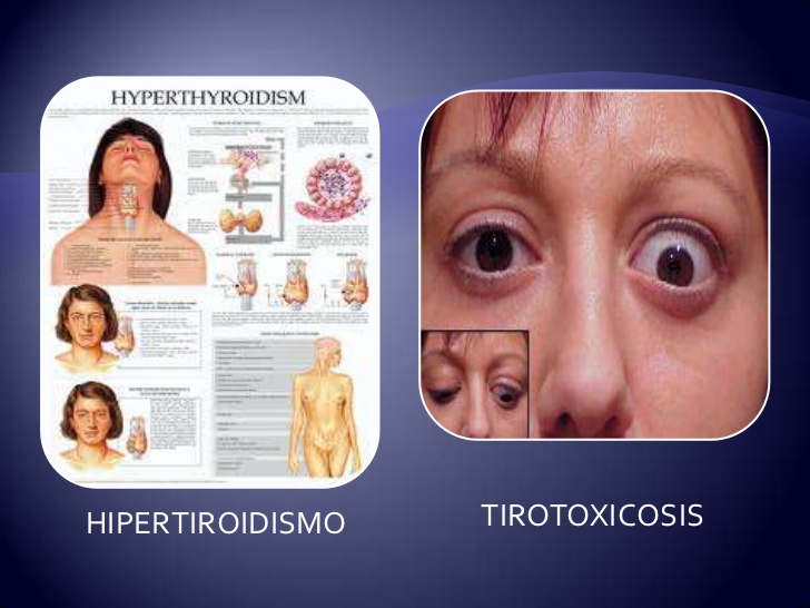 What Is Thyrotoxicosis? - Teroes