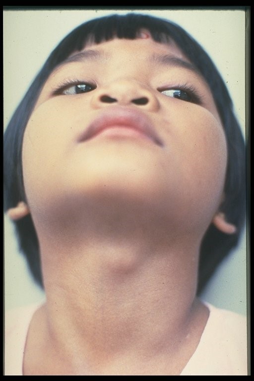 ER goldbook: Pediatric: neck masses