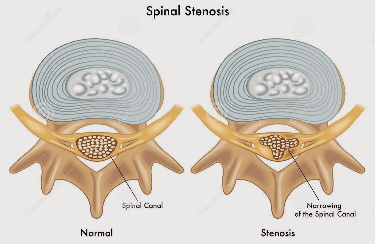 June 2014 | Cervical Spinal Stenosis Surgery