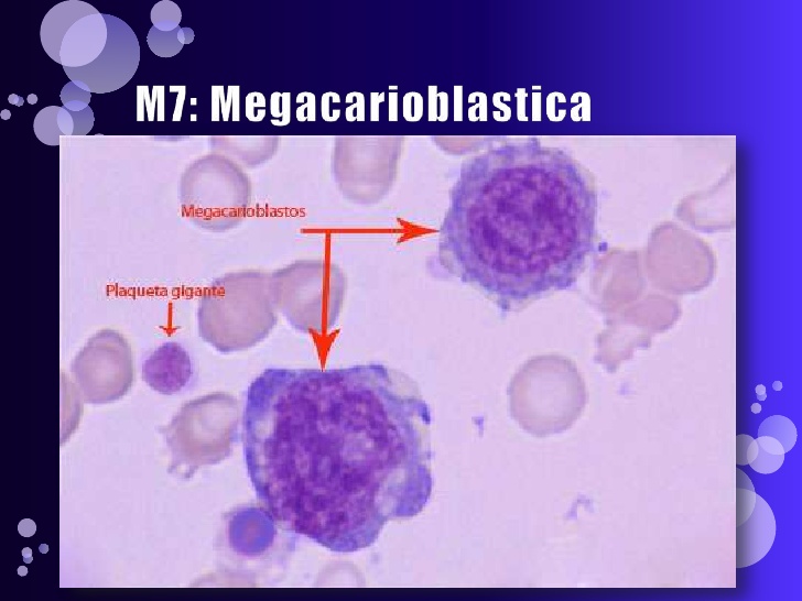 Células Sanguíneas: Leucemias Mieloides Agudas