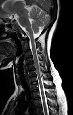 WORLD OF RADIOLOGY: Epidural Hematoma