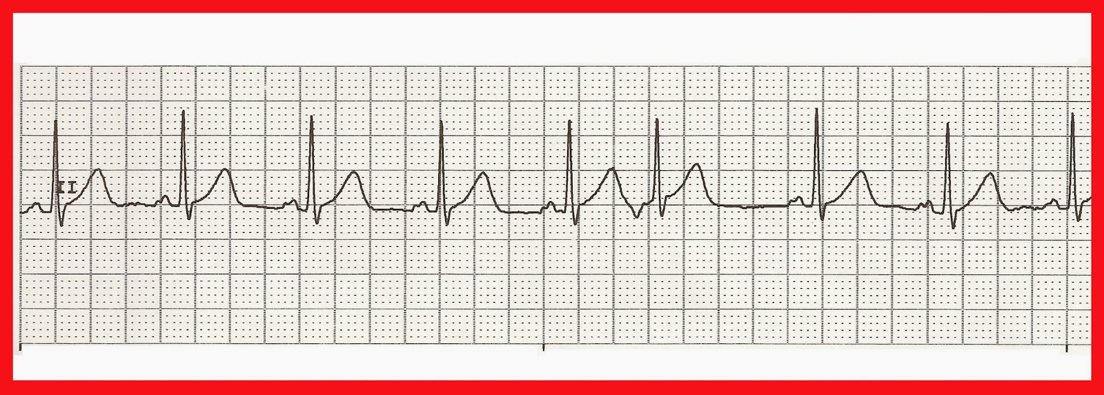 Float Nurse: EKG Rhythm Strip Quiz 192