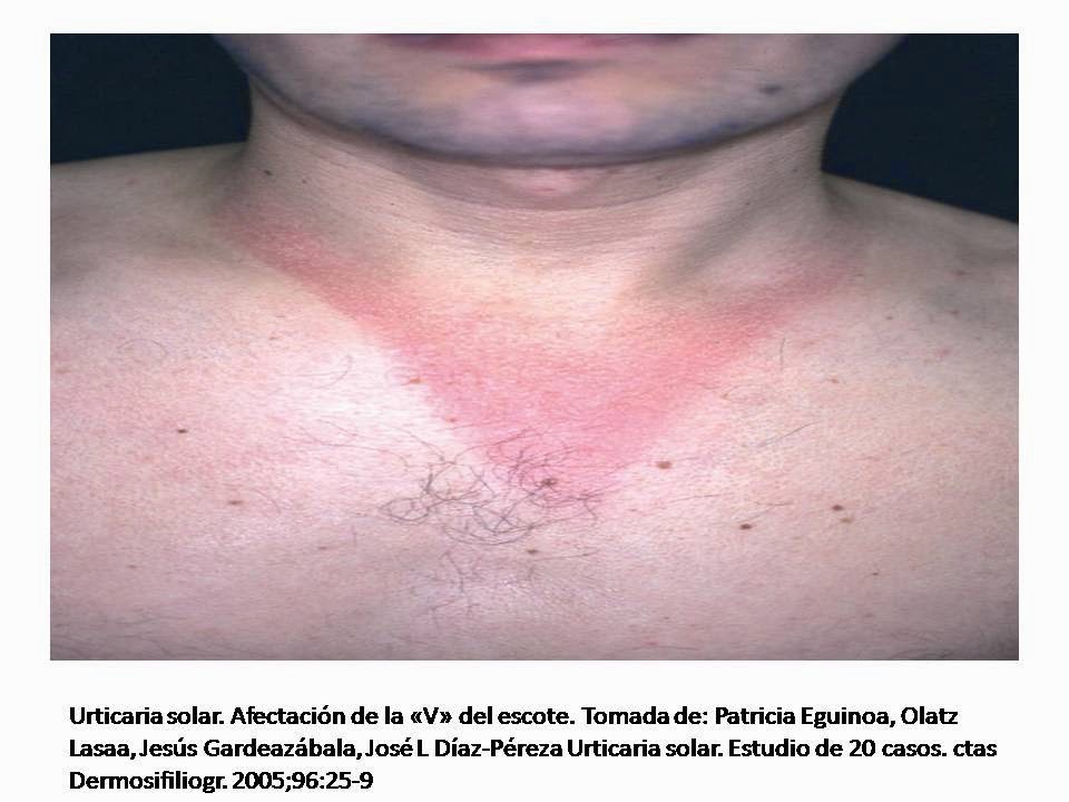 Urticaria solar