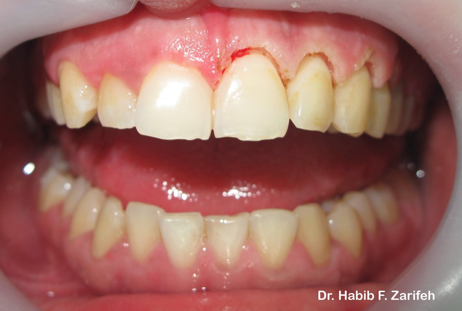 Gummy Smile Beirut: Gummy smile Beirut Lebanon by Dr.Habib Zarifeh the ...