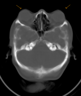 Oxycephaly-CT - Sumer's Radiology Blog