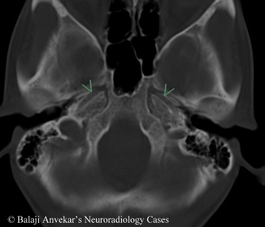 Dr Balaji Anvekar FRCR: Bilateral ICA hypoplasia