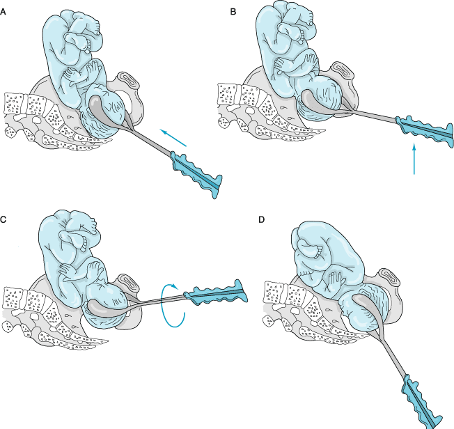 học Y: forceps - ventouse