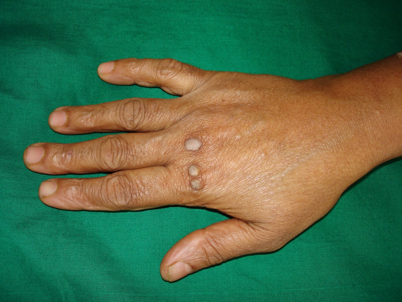 Dr Joseph Chalissery: WHAT ARE WARTS???